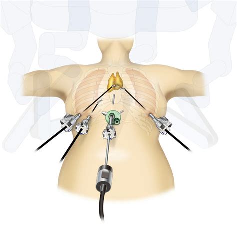 Location Of Ports In The Subxiphoid Approach Download Scientific Diagram Location Of Ports In The Subxiphoid Approach Download Scientific Diagram