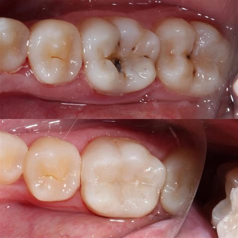 Resin Based Composite Two Surfaces Posterior