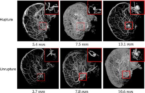 Figure 1 From A Deep Learning Method For The End To End Prediction Of Intracranial Aneurysm