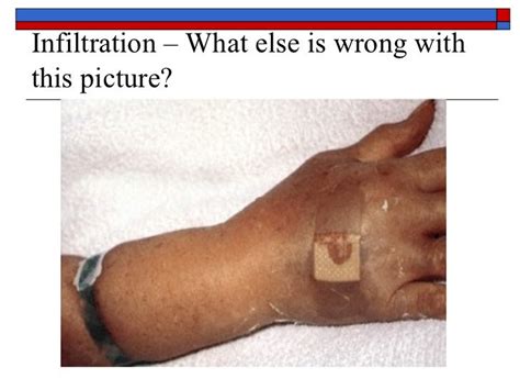 Intra Venous Therapy Complications
