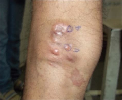 Myxoinflammatory Fibroblastic Sarcoma An Uncommon Tumour At An Unusual