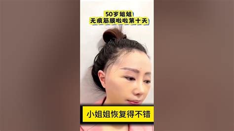 50岁小姐姐恢复10天后 太满意了 自信 开心 美女 整形 Youtube