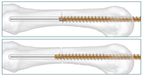 Threaded Hand Nail Skeletal Dynamics