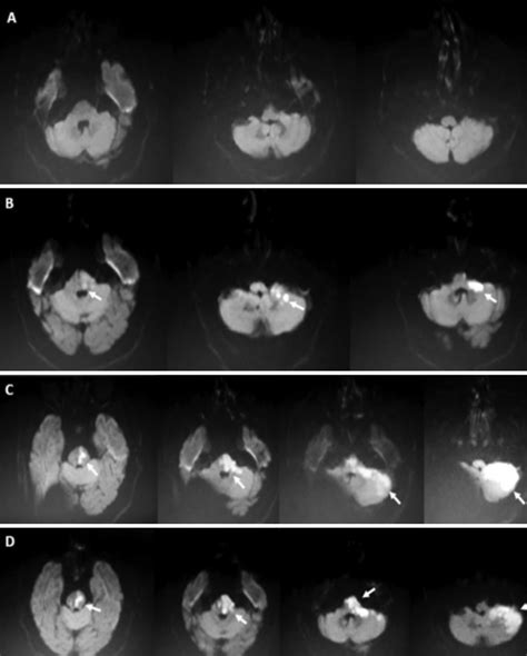 A Diffusion Weighted Imaging Dwi Performed At First Admission Download Scientific Diagram