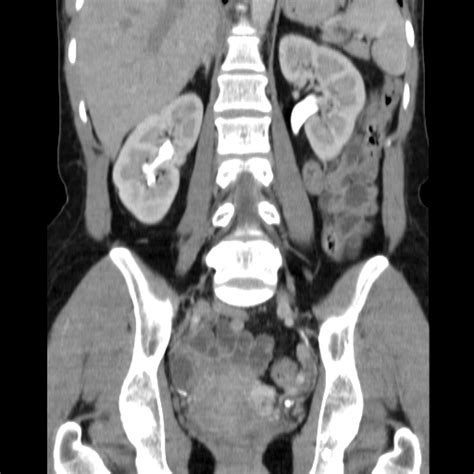 Nyre Normal Ct 2 Lægehåndbogen På Sundheddk