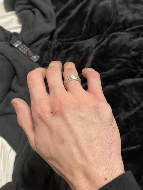 Broken 5th Metacarpal R Brokeabone