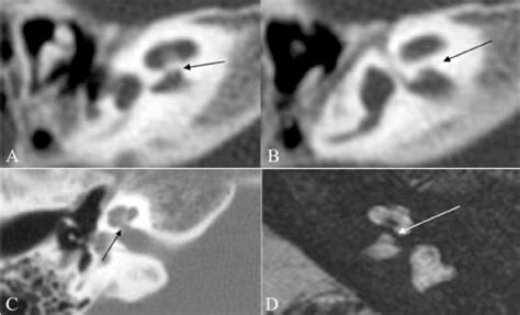 A D Isolated Cochlea Axial Hrct Images A B Show A Thick Bony Bar Download Scientific