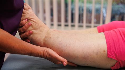 The Four Lymphedema Stages From Symptoms To Treatment