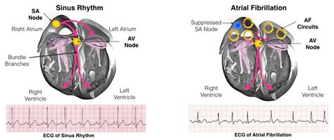 Atrial Fibrillation Pacemaker And Av Node Ablation Melbourne Heart Rhythm