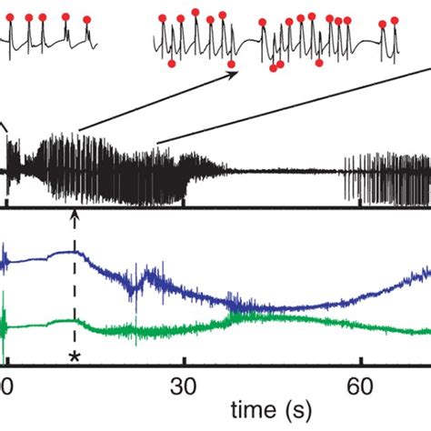 Typical Chronically Recorded Spontaneous Seizure From The Tetanus Toxin