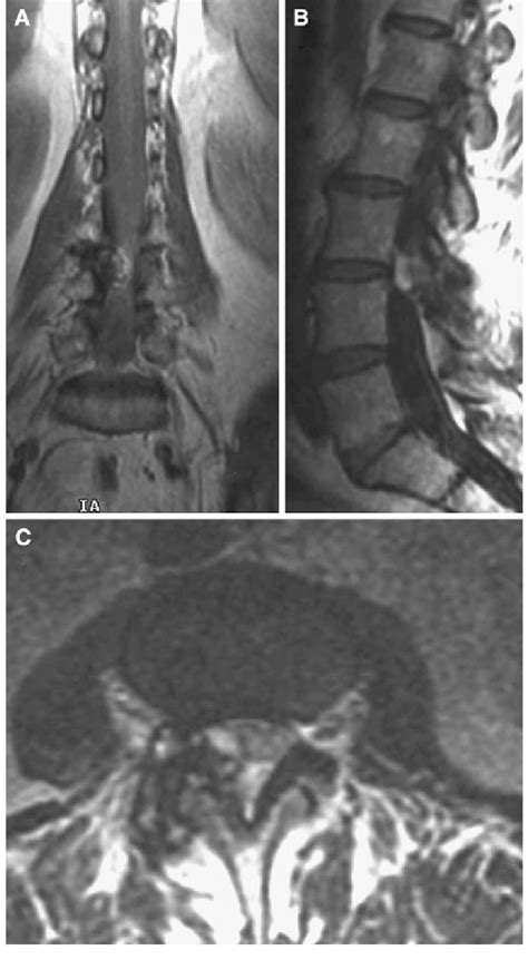 Mr Images Showing A Juxtafacet Lesion Located At L3 L4 Which Is