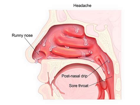 Mucus In Throat And Nose 5 Foods To Eat And Avoid