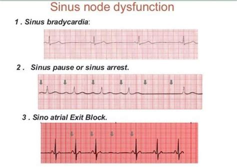 Sinus Node Dysfunction Medizzy