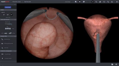 Hysteroscopic Polypectomy Surgical Science Hysteroscopic Polypectomy Surgical Science