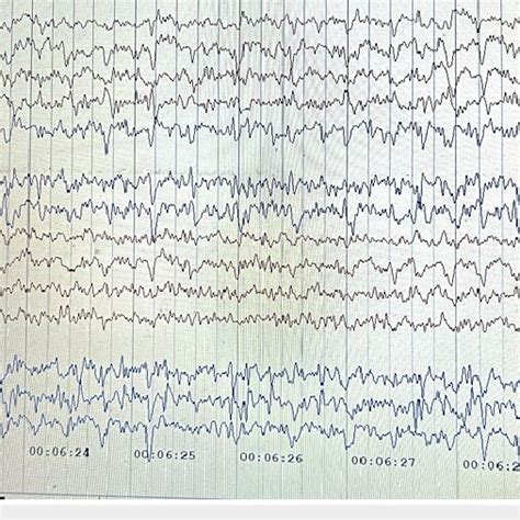Triphasic Waves Visible On The Electroencephalogram Against A Slow Wave Download Scientific