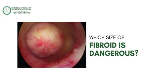 Which Size Of Fibroid Is Dangerous The Medison Hostpital