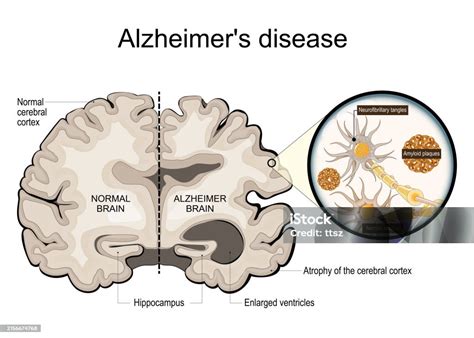 Alzheimer Disease Hippocampus Closeup Of Neurons With Neurofibrillary Tangles And Amyloid