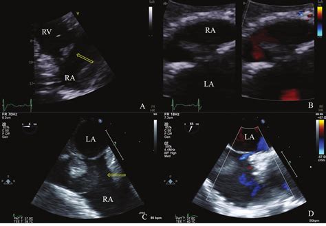A TTE In The Parasternal RV Inflow View Showing A Shaggy Appearing Download Scientific