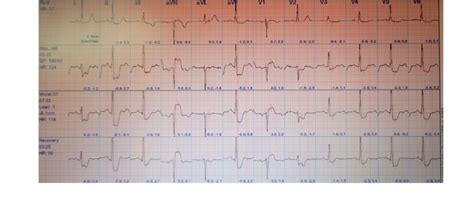 Brandy Viera Valdes On Linkedin Terrifying Ecg During A Stress Echo Test Global Hypokinesis