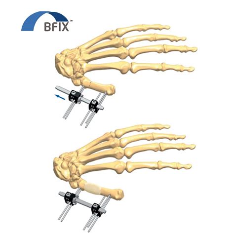 Mini Fixator Lengthening Of 1st Metacarpal By Callotasis In A Patient With Amputation Of The
