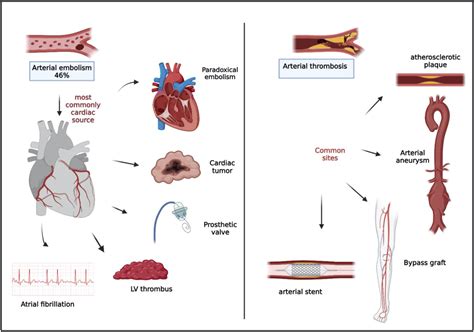 Acute Limb Ischemia Interventions Interventional Cardiology Clinics