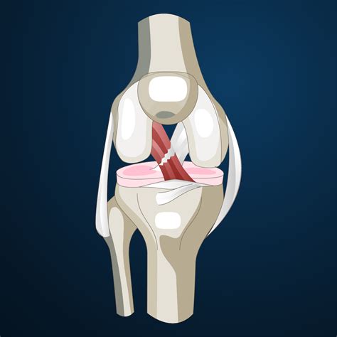 Anterior Cruciate Ligament Acl Injury