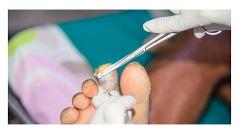 Grafix Cryopreserved Placental Membrane