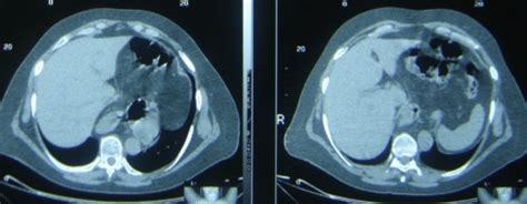 Thoracic Ct Scan Confirmed The Diagnosis Of A Left Bochdalek Hernia