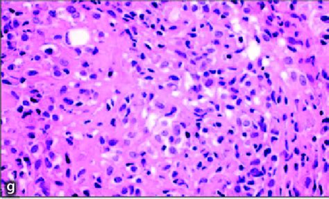 G Malignant Cells Trapped By Malignant Osteoid Hematoxylin Eosin