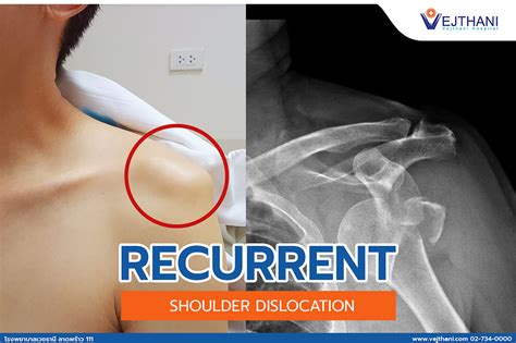Recurrent Shoulder Dislocation” Is Treatable
