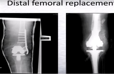 Balancing Simplicity With Complexity Pre Op Planning For Periprosthetic Femur Fractures