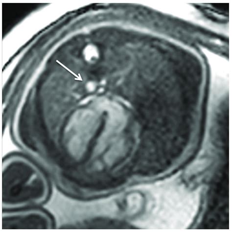 Fetal Cardiac Mri Using Doppler Ultrasound Gating At 3 Tesla The