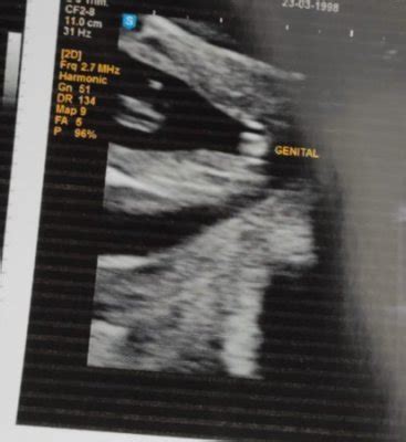 Ultrassom sexo do bebê BabyCenter