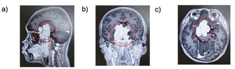 Giant Prolactin Secreting Pituitary Adenoma A Case Report And