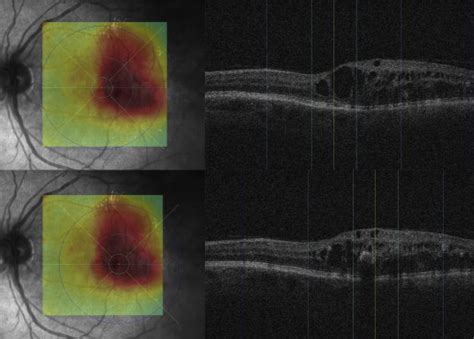 Three Dimensional Automated Choroidal Volume Assessment On Standard Spectral Domain Optical