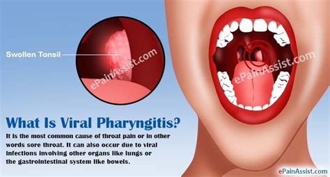 Antibiotics For Swollen Tonsils