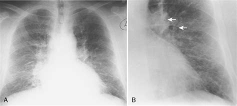 Cephalization Of Pulmonary Vessels