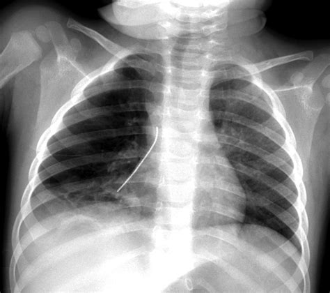 Lung Hyperlucency Chest Lung Hyperlucency Chest