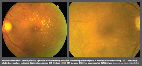 Deep Learning Predicts Oct Measures Of Diabetic Macular Thickening Ophthalmology Times