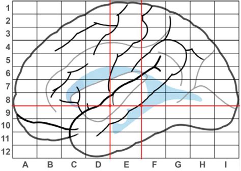 Stereotactic Electroencephalography Seeg Intechopen