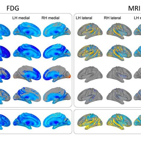 Voxel Wise Linear Regression Analysis Of Brain Age Gap 764 765 Download Scientific Diagram