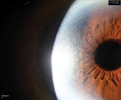 Corneal Deposits