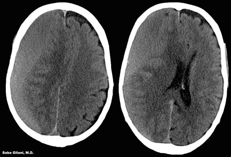 Roentgen Ray Reader Isodense Subdural Hematoma