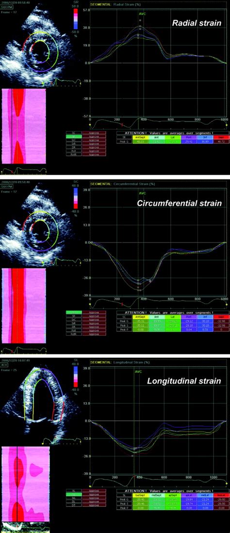 Preserved Lv Systolic Function Meaning Ahoy Comics