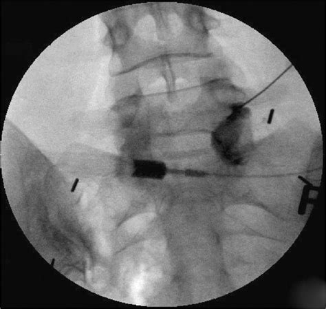Cortisone Injections L5 S1 Facet Joints At Rebecca Montgomery Blog