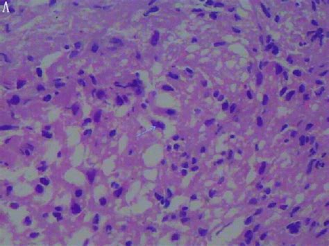 Reveals A Lymphocyte Infiltrated Abscess Wall The Arrow Indicates A Download Scientific