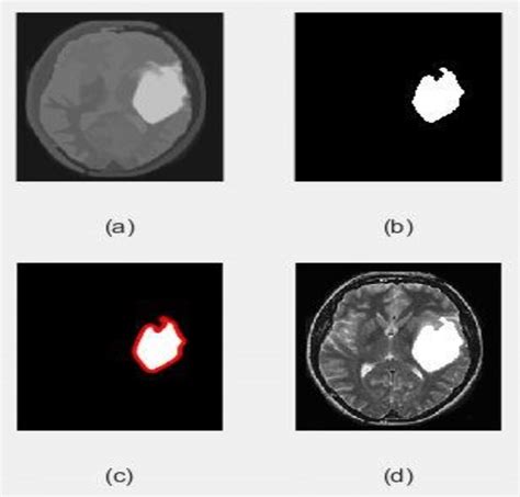 Brain Tumor Segmentation A Complement Of Figure 6f B Tumor Area Download Scientific