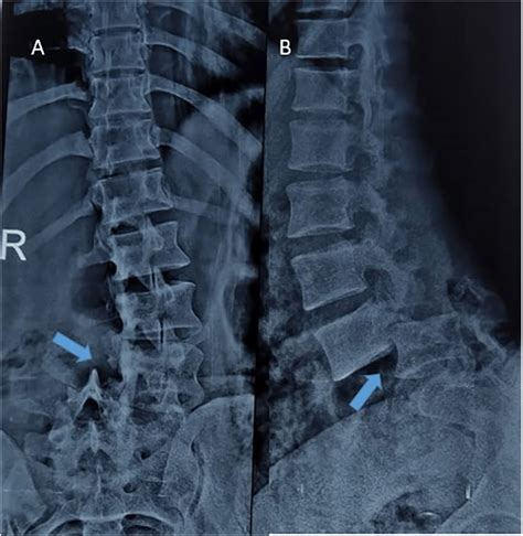 Ap A And Lat B Views Involving Thoraco Lumbo Sacral Spine Meyerding