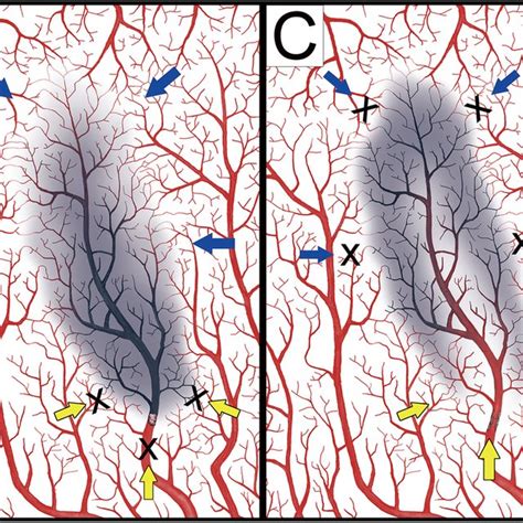 illustration of different perfusion patterns with or without