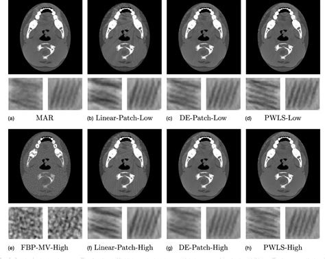 Figure 5 From Metal Artifact Correction For X Ray Computed Tomography Using Kv And Selective Mv